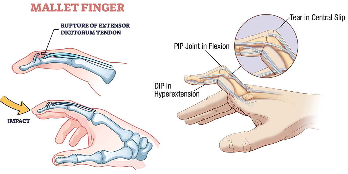 Basketball Finger Tape | Why Use It | How To Tape Fingers